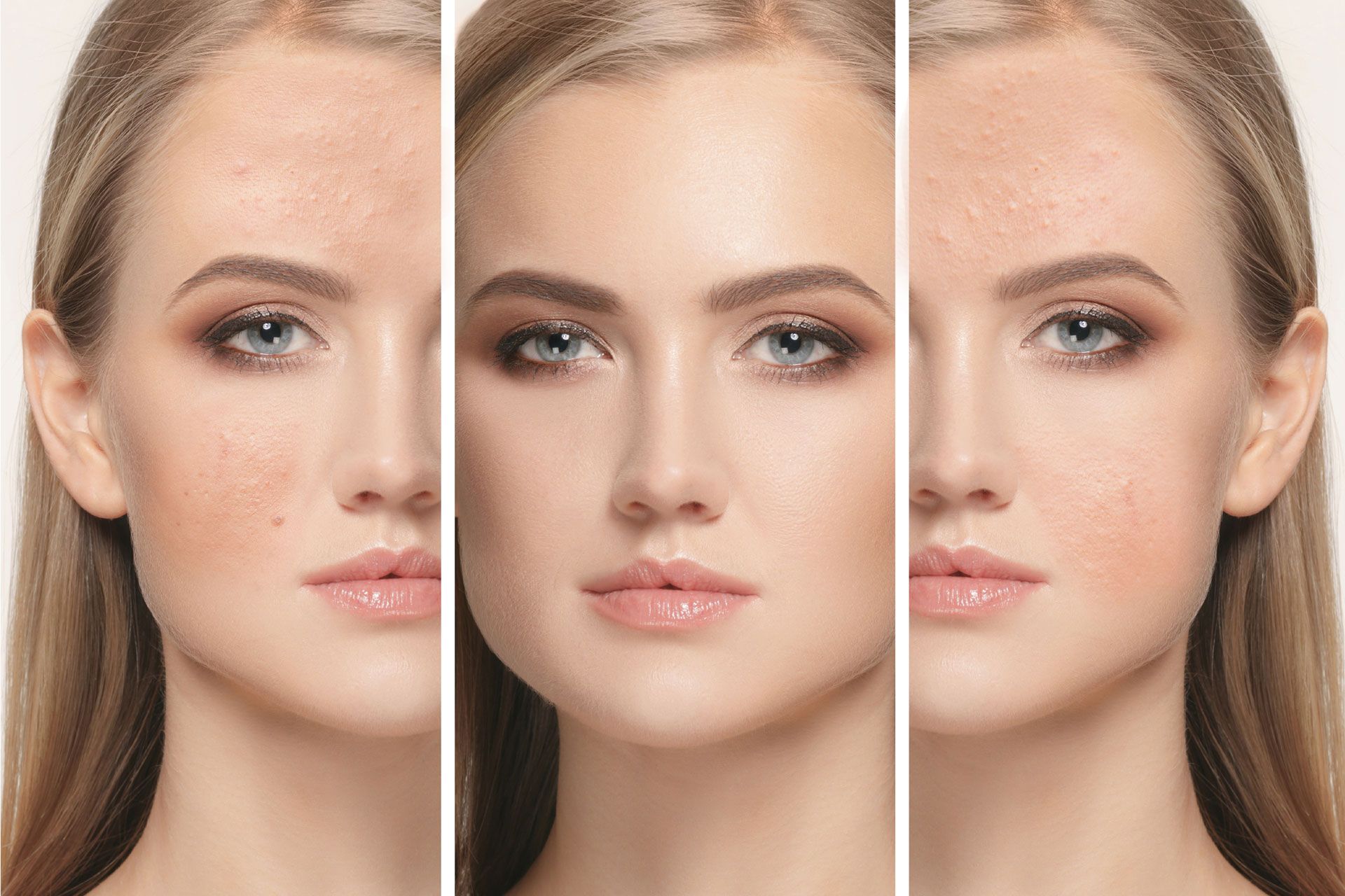 Acne behandeling Amsterdam | Unicare Cosmetic Clinic