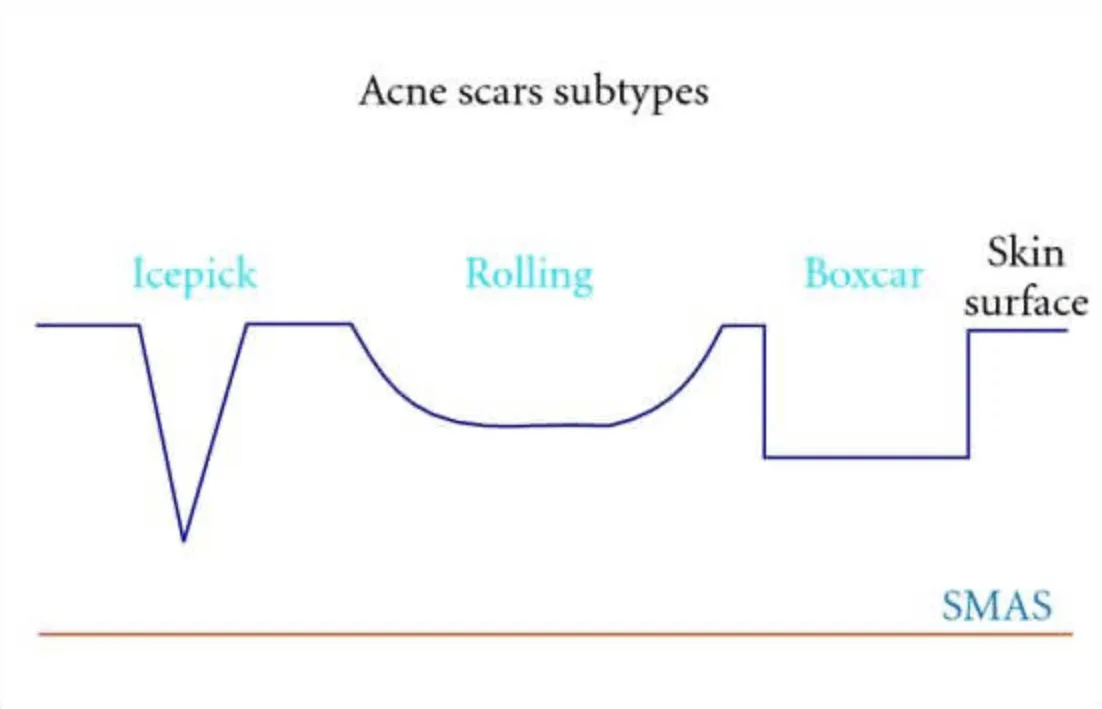 Acne Littekens: De Impact van Acne op je Huid - Huidproblemen | Unicare ...